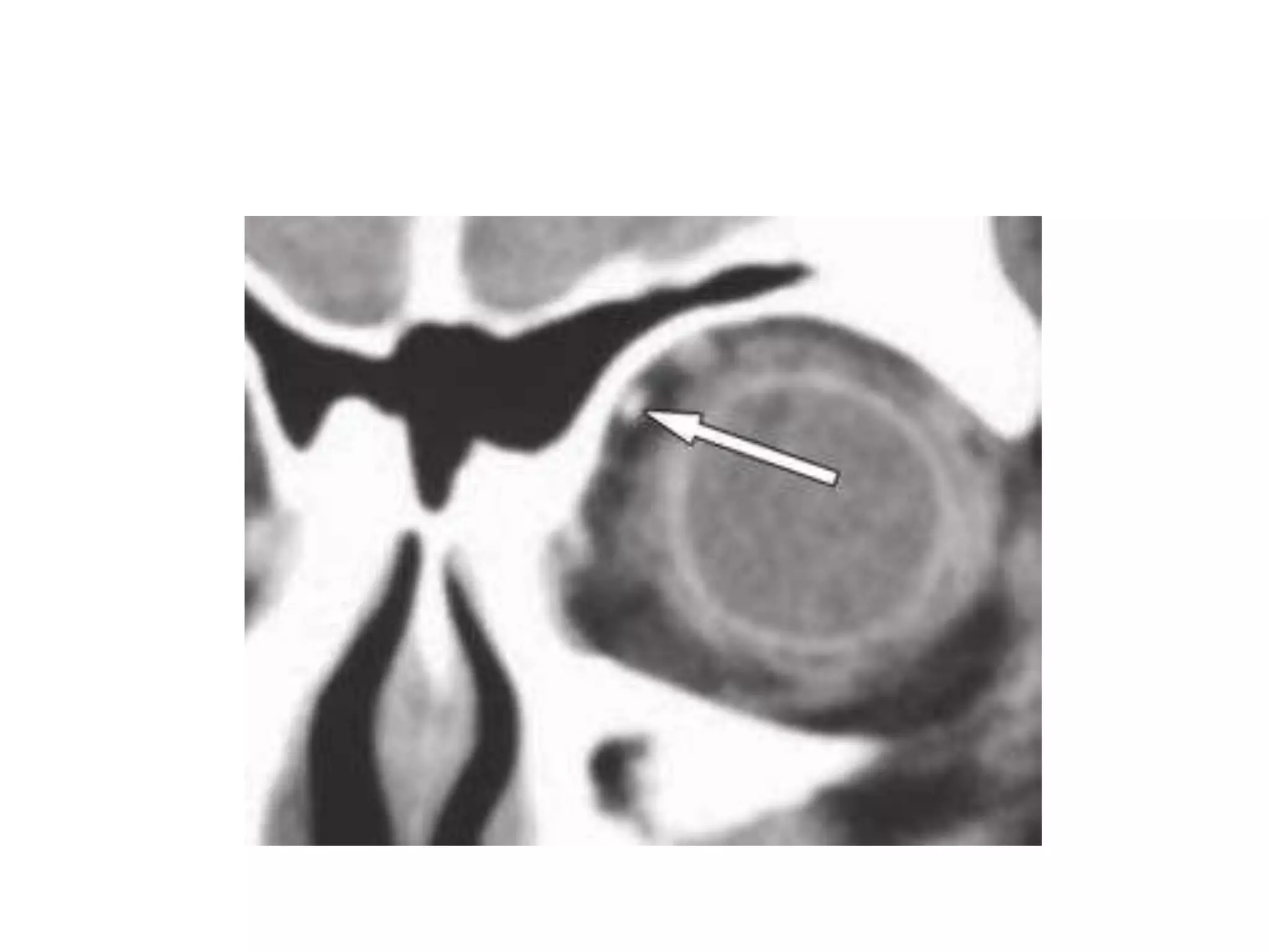 Orbital Calcification | PPTX