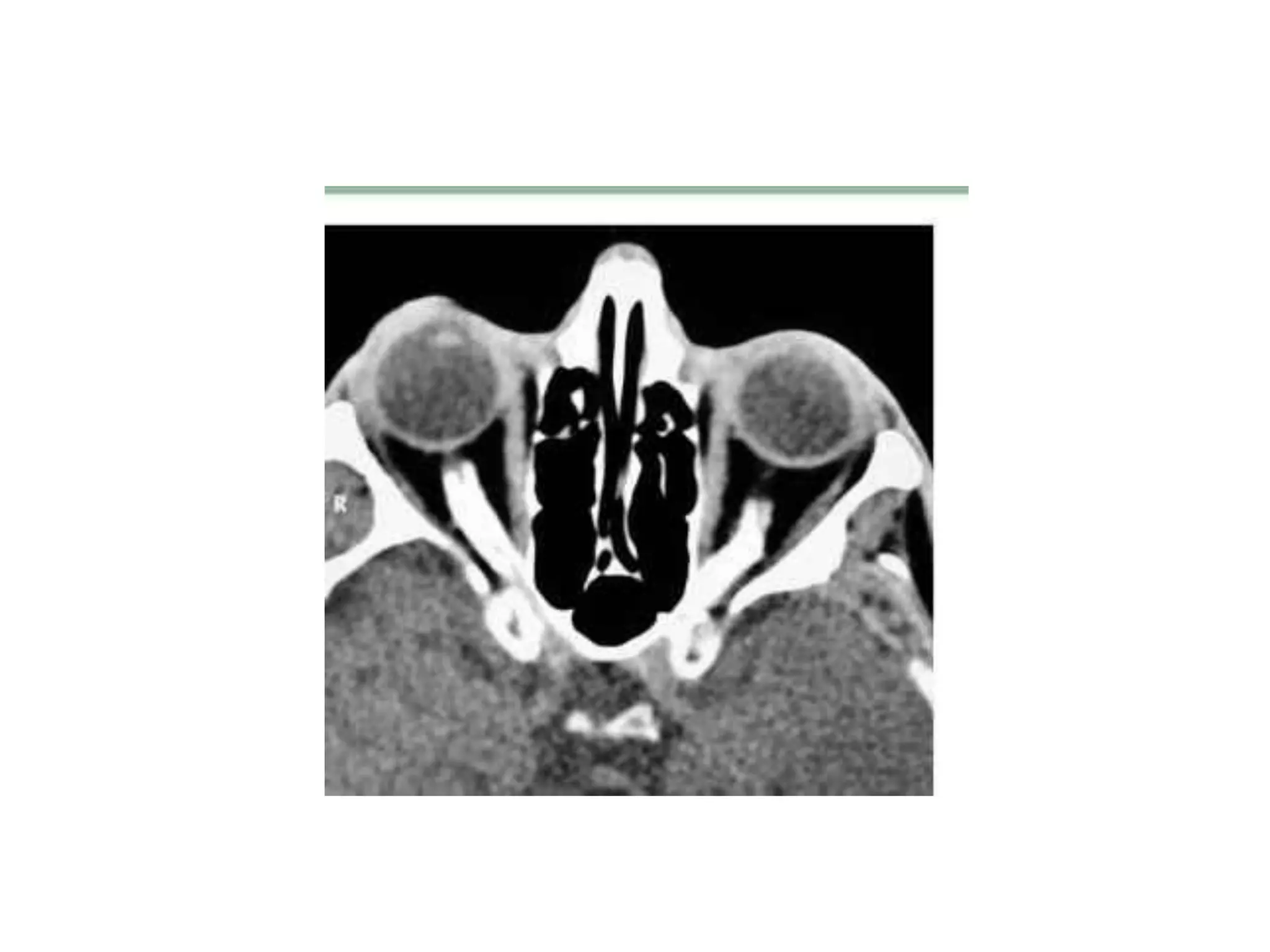 Orbital Calcification | PPT