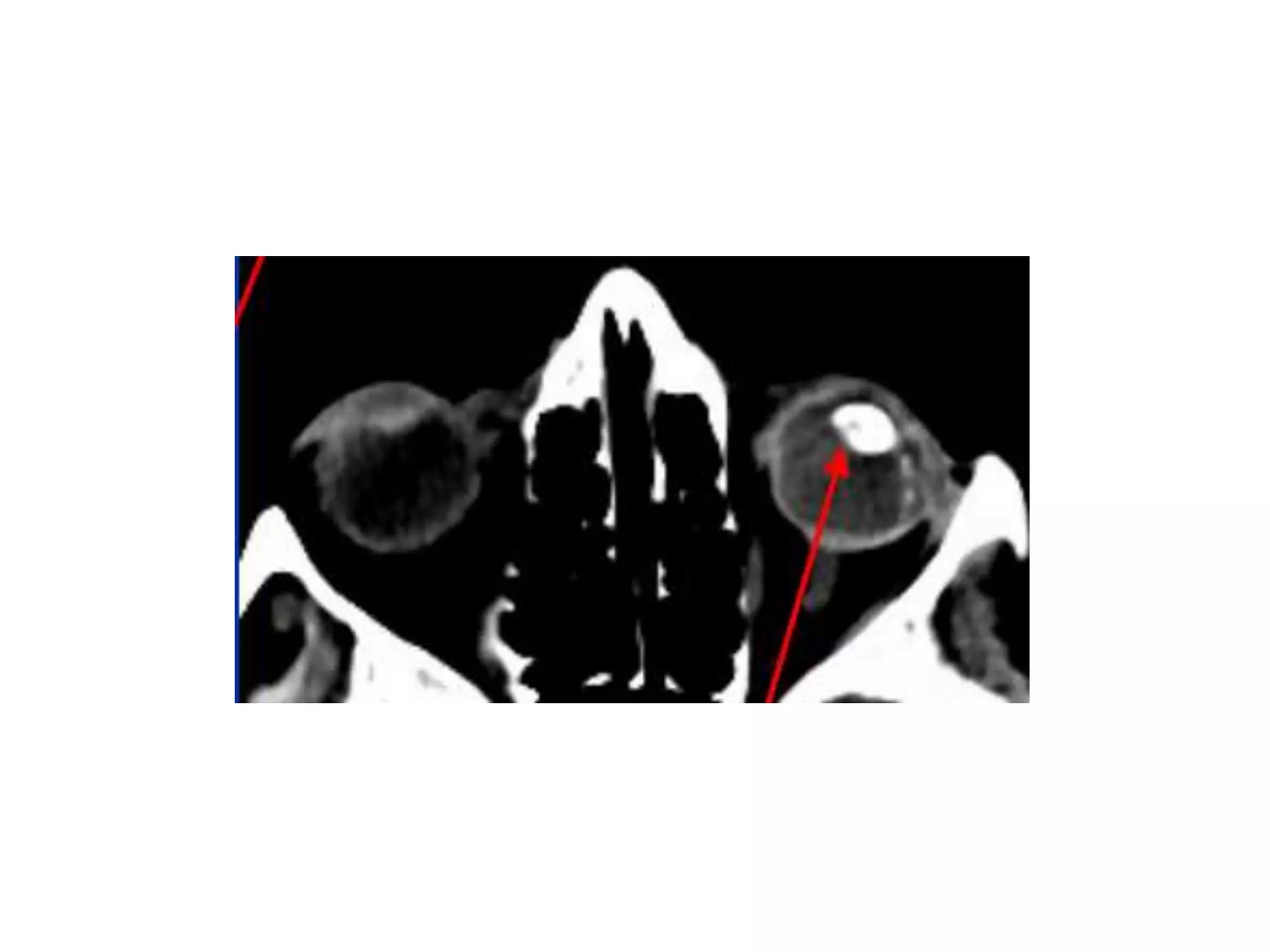 Orbital Calcification | PPTX