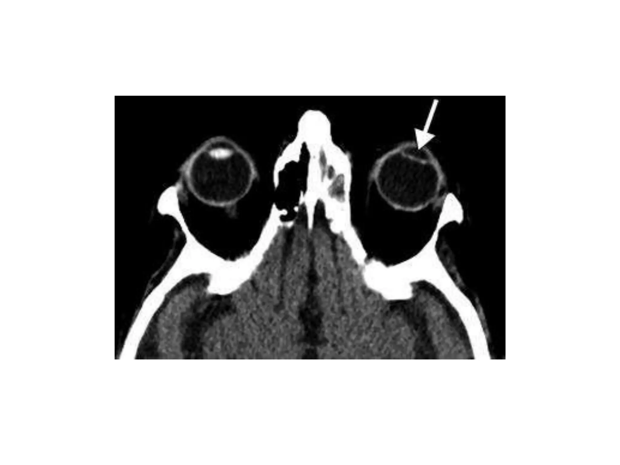 Orbital Calcification | PPT