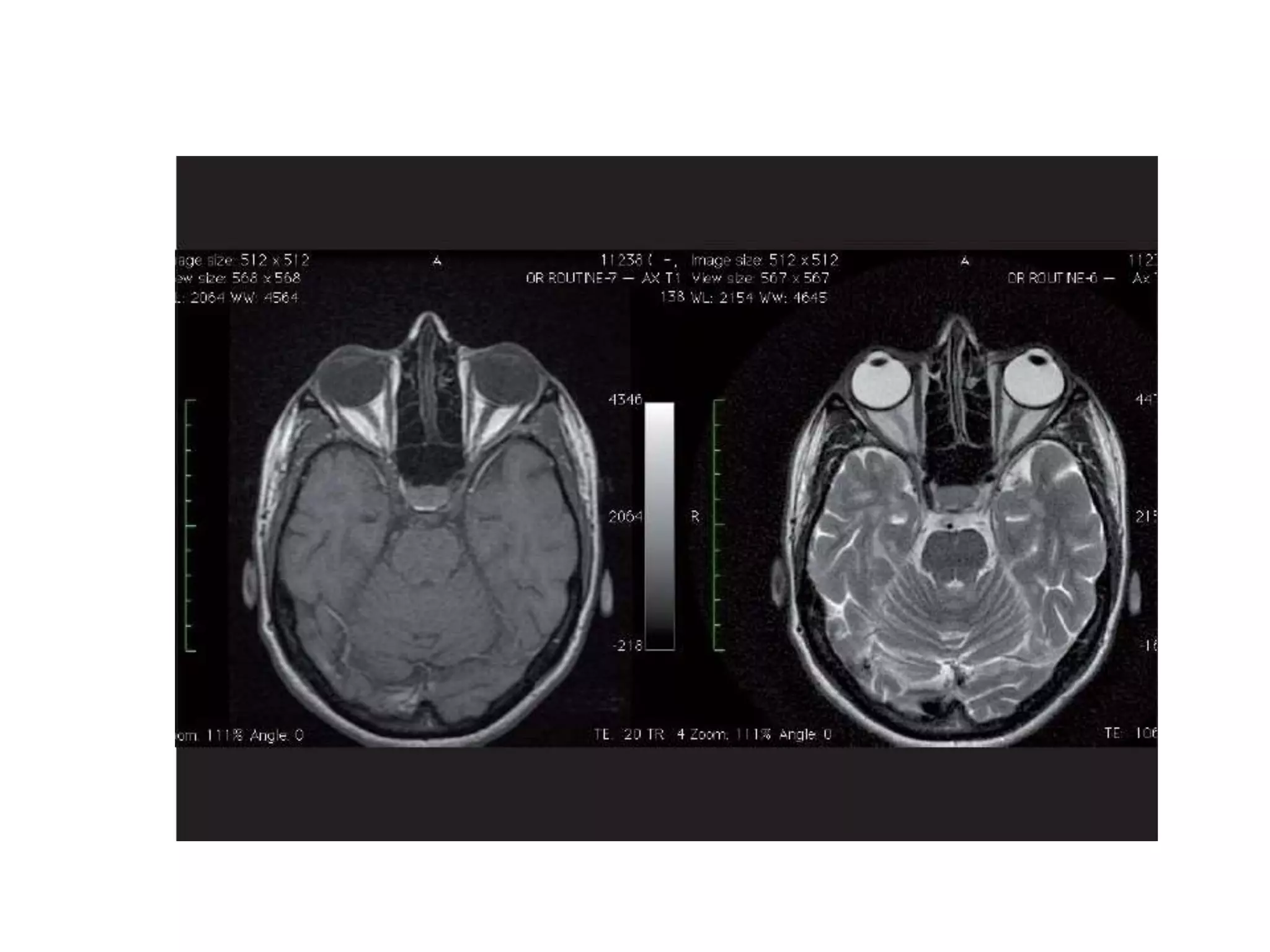 Orbital Calcification | PPT