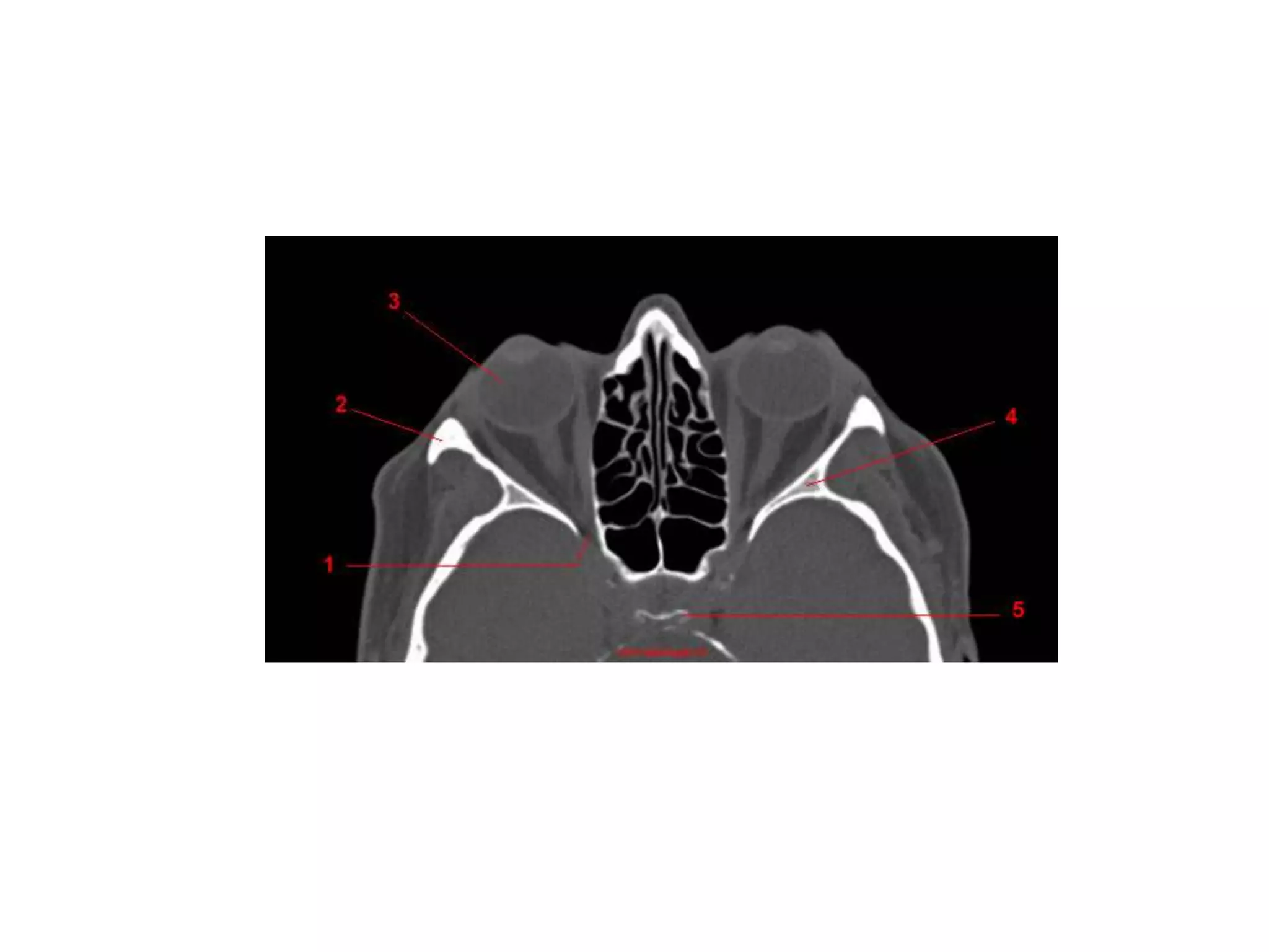 Orbital Calcification | PPT