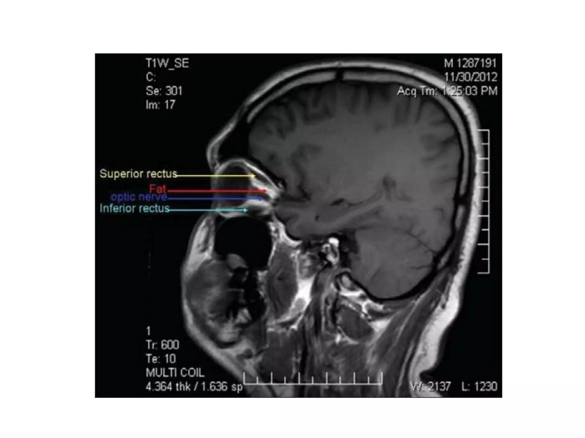 Orbital Calcification | PPTX