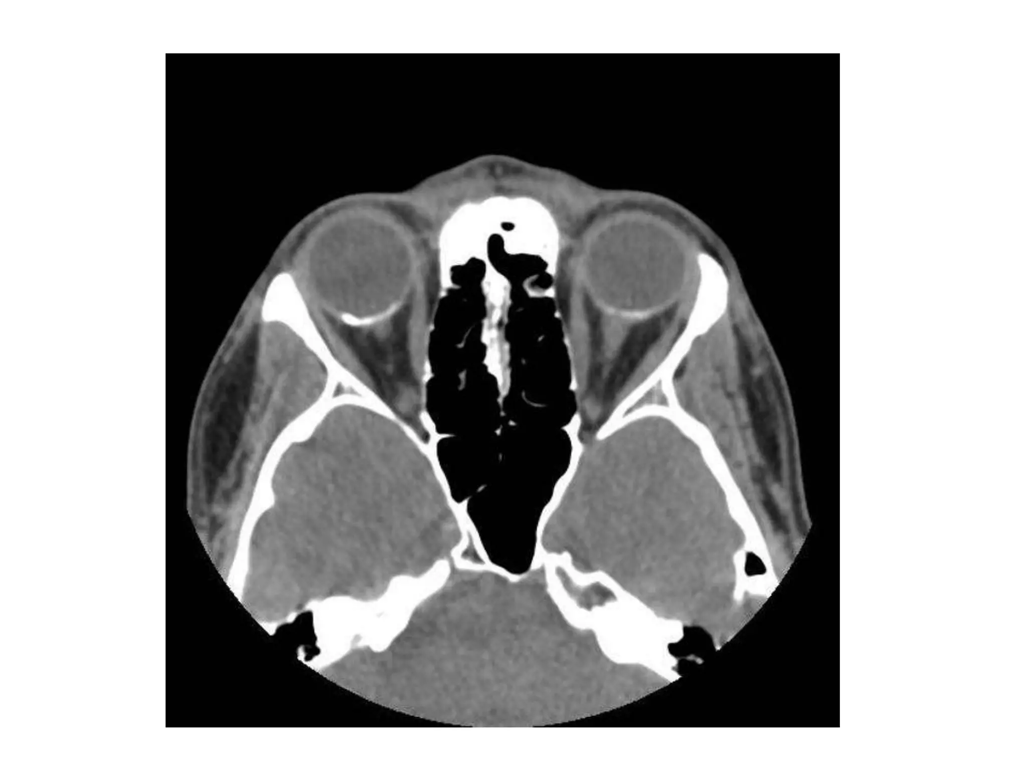 Orbital Calcification | PPTX