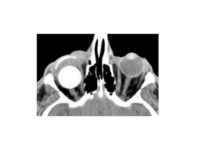 Orbital Calcification | PPTX