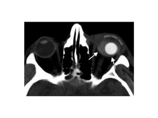 Orbital Calcification | PPT