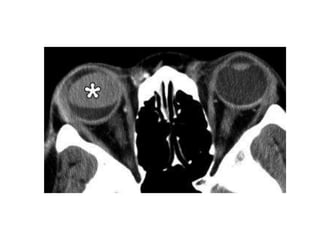 Orbital Calcification | PPT