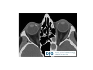 Orbital Calcification | PPT
