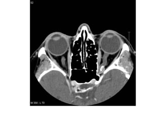 Orbital Calcification | PPT