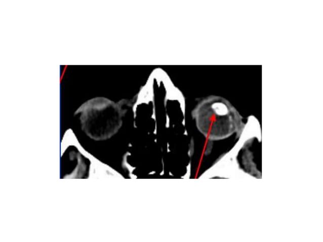 Orbital Calcification | PPTX