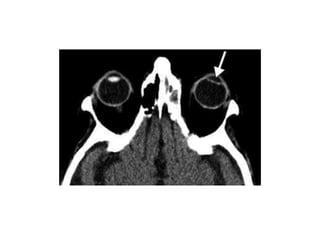 Orbital Calcification | PPT