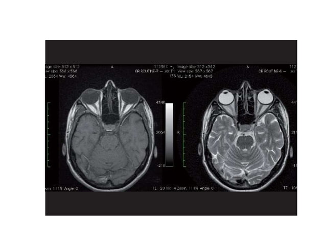 Orbital Calcification | PPTX