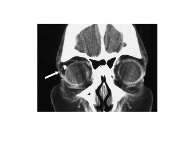 Orbital Calcification | PPTX