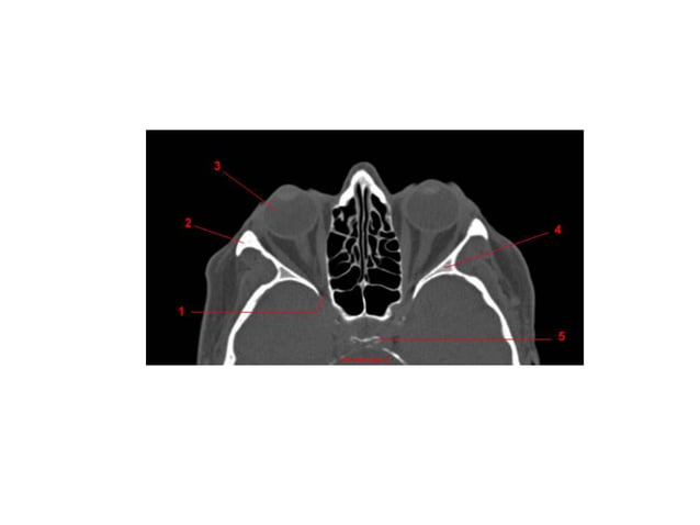 Orbital Calcification | PPTX