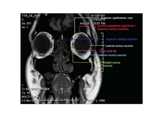 Orbital Calcification | PPT