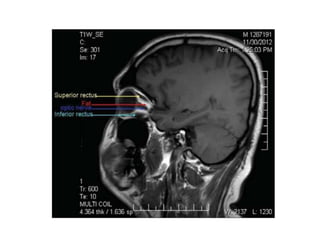 Orbital Calcification | PPT