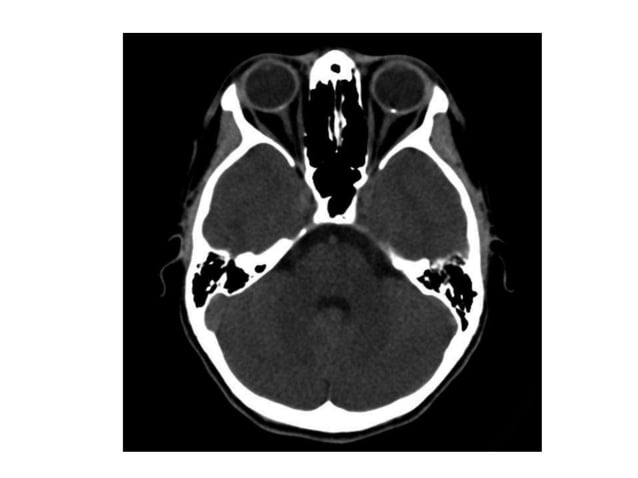 Orbital Calcification | PPTX