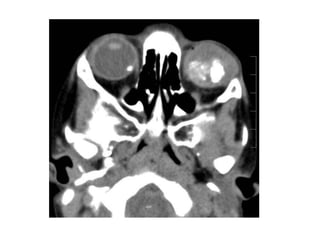 Orbital Calcification | PPT