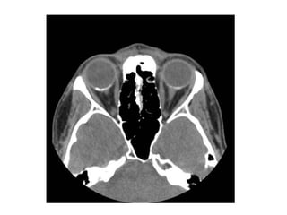 Orbital Calcification | PPT