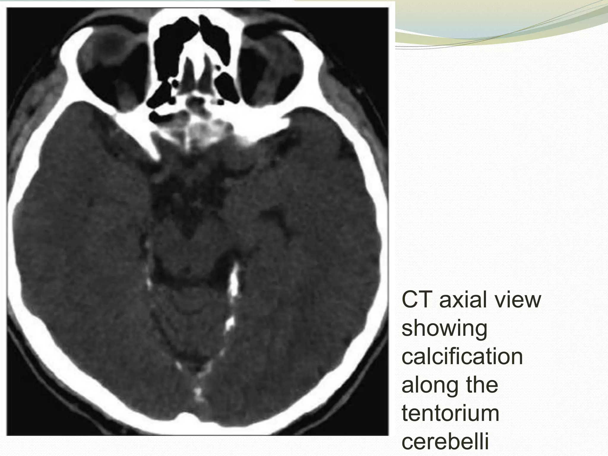 PHYSIOLOGICAL AND PATHOLOGICAL CALCIFICATION OF BRAIN | PPTX