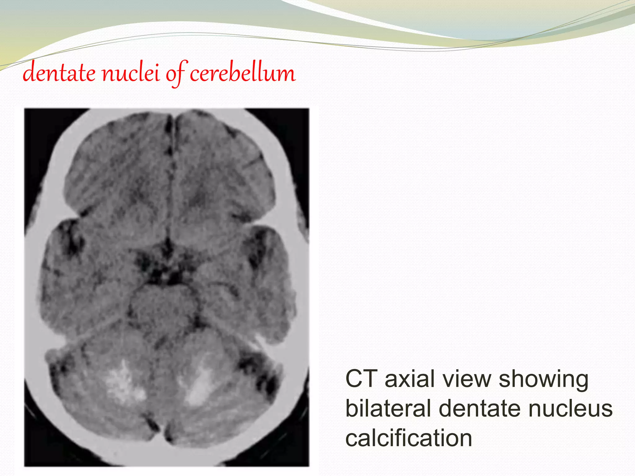 PHYSIOLOGICAL AND PATHOLOGICAL CALCIFICATION OF BRAIN | PPTX