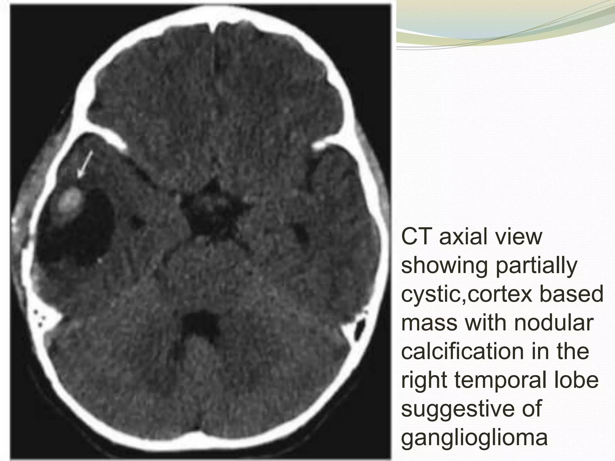 PHYSIOLOGICAL AND PATHOLOGICAL CALCIFICATION OF BRAIN | PPTX
