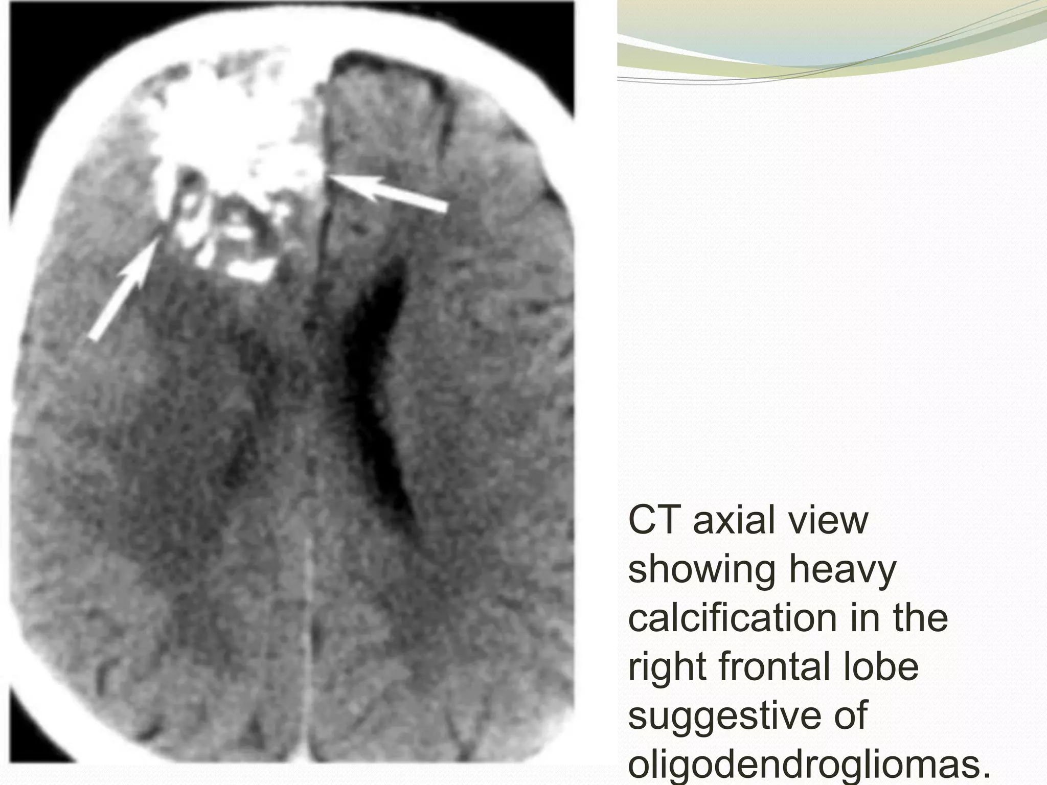 PHYSIOLOGICAL AND PATHOLOGICAL CALCIFICATION OF BRAIN | PPTX