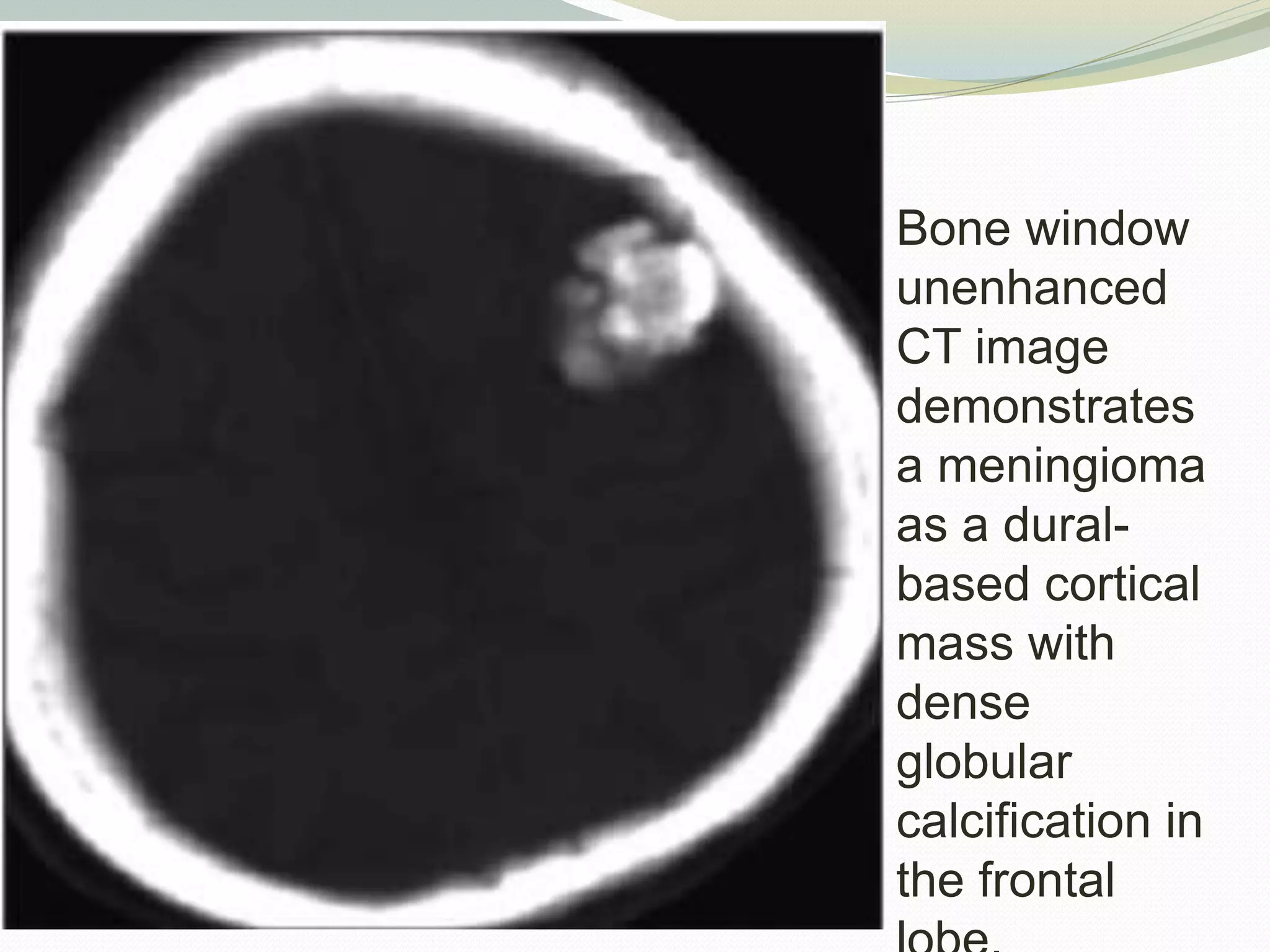 PHYSIOLOGICAL AND PATHOLOGICAL CALCIFICATION OF BRAIN | PPTX