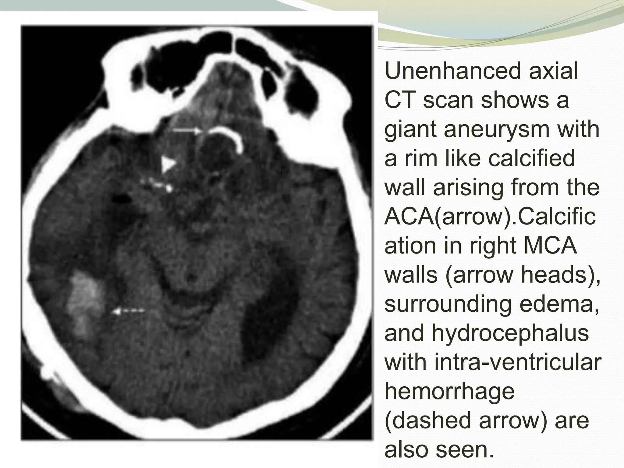 PHYSIOLOGICAL AND PATHOLOGICAL CALCIFICATION OF BRAIN | PPTX
