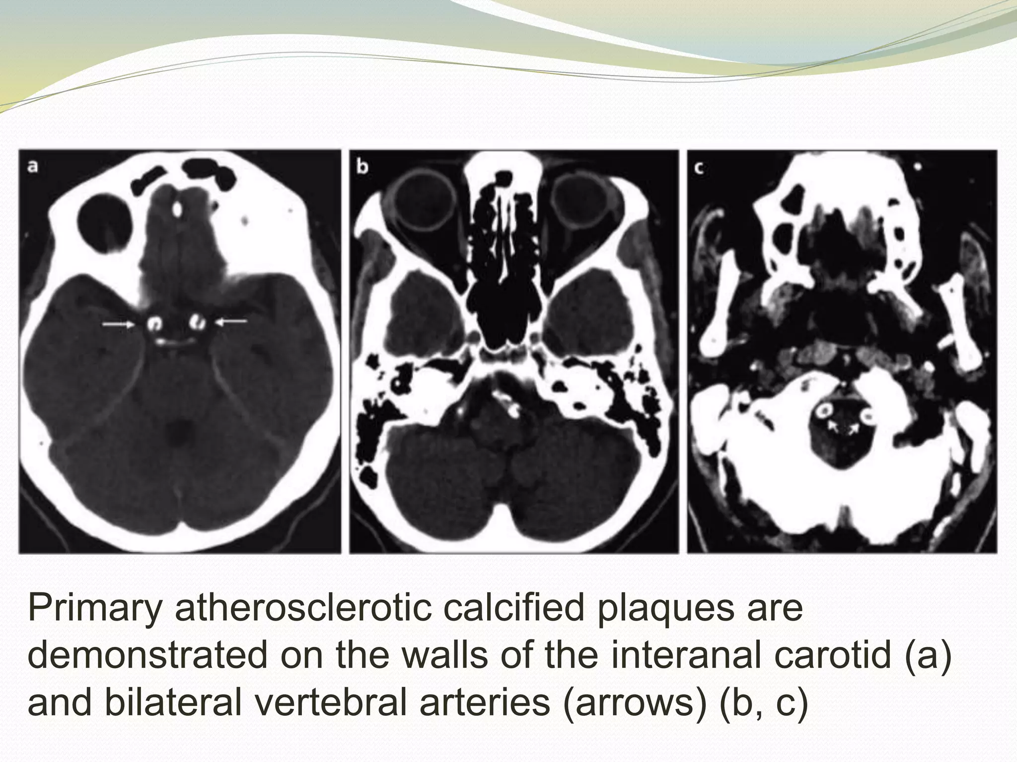 PHYSIOLOGICAL AND PATHOLOGICAL CALCIFICATION OF BRAIN | PPTX