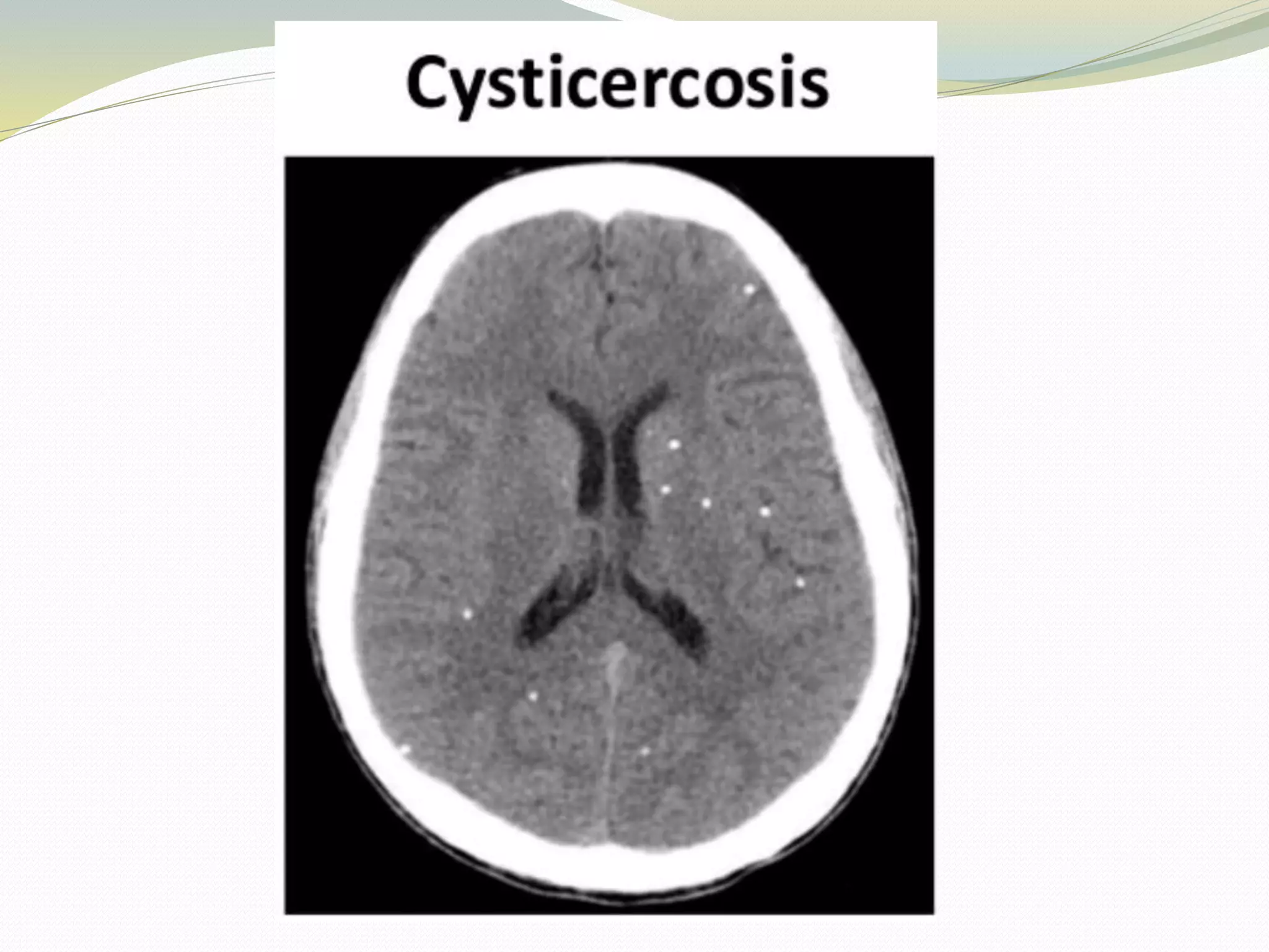 PHYSIOLOGICAL AND PATHOLOGICAL CALCIFICATION OF BRAIN | PPTX