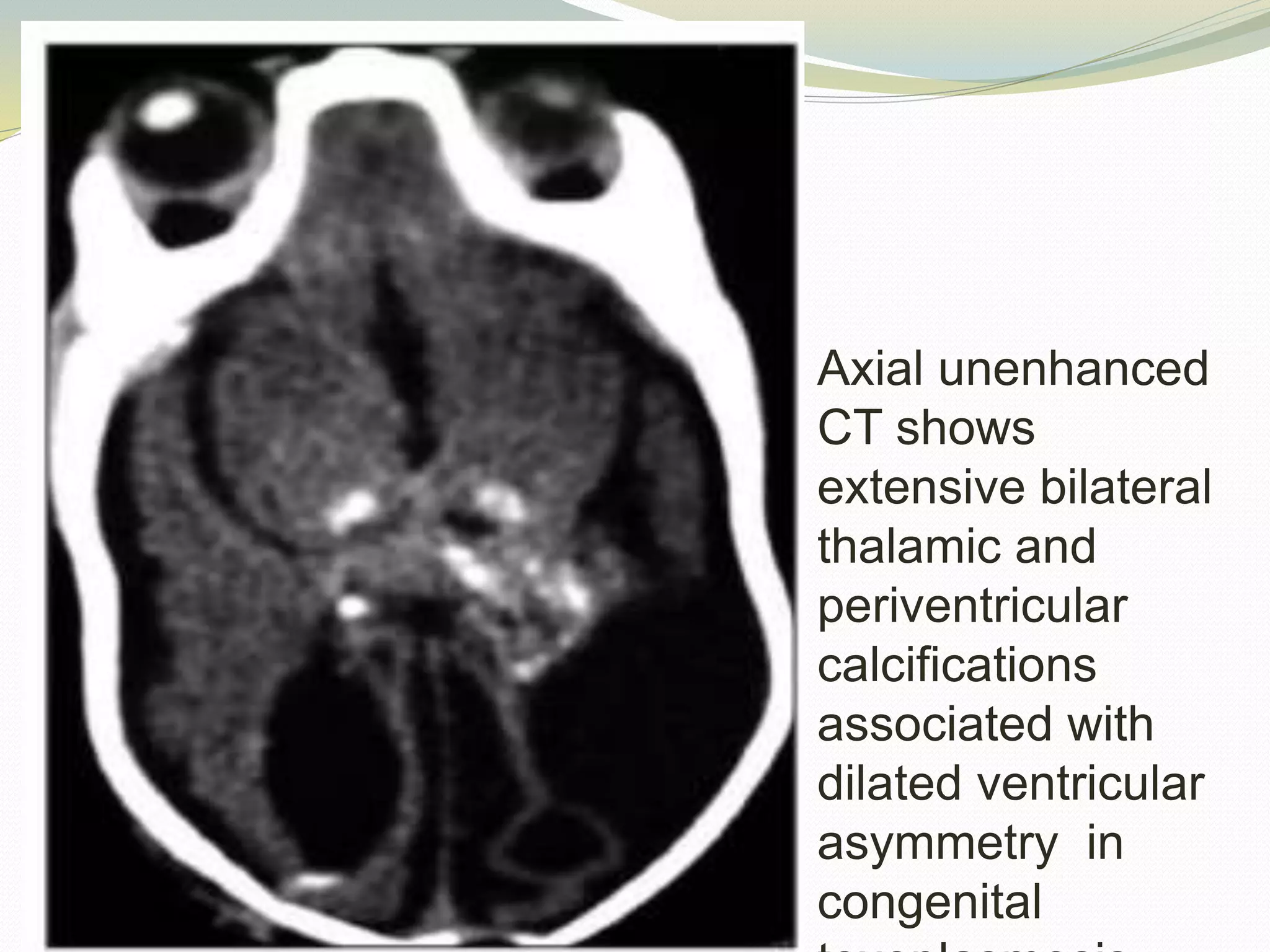 PHYSIOLOGICAL AND PATHOLOGICAL CALCIFICATION OF BRAIN | PPTX