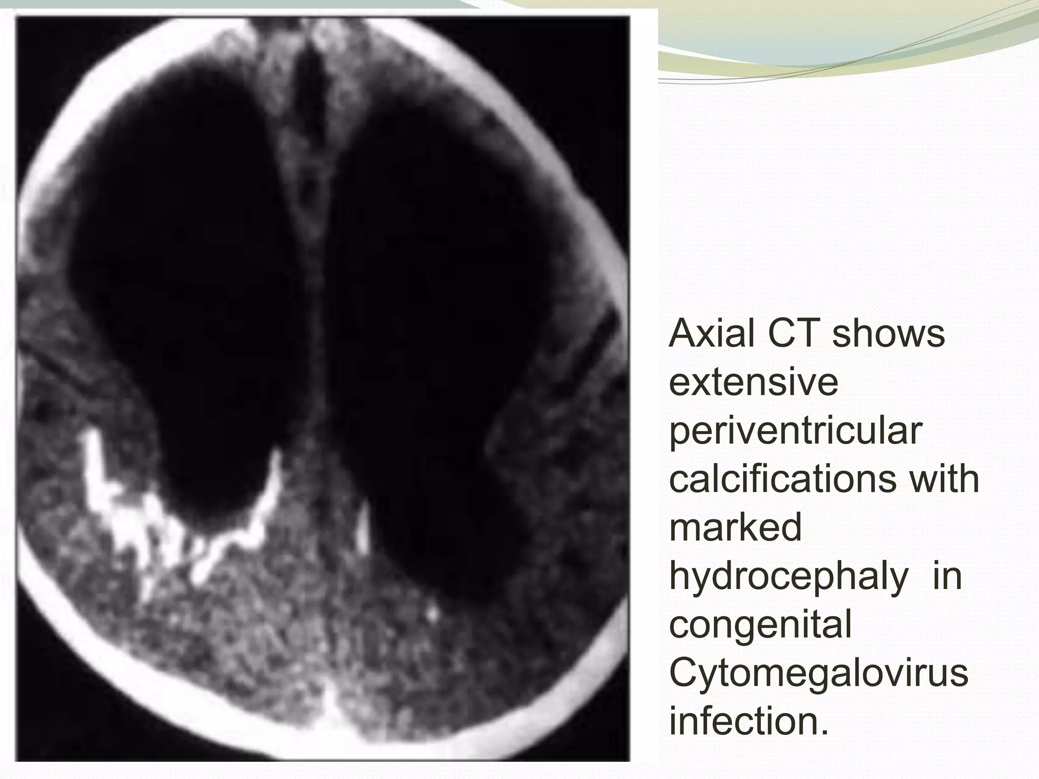 PHYSIOLOGICAL AND PATHOLOGICAL CALCIFICATION OF BRAIN | PPTX