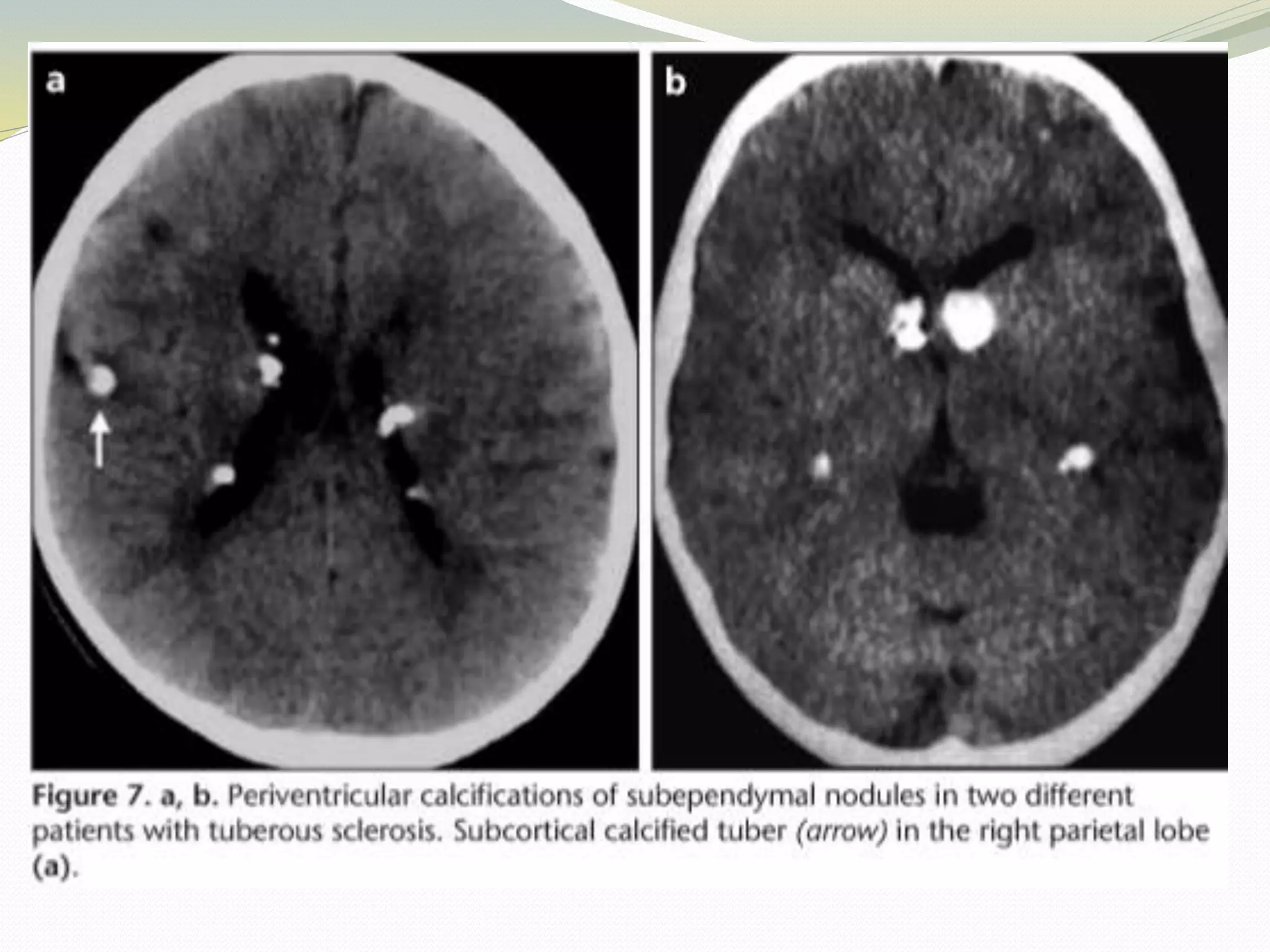 PHYSIOLOGICAL AND PATHOLOGICAL CALCIFICATION OF BRAIN | PPTX