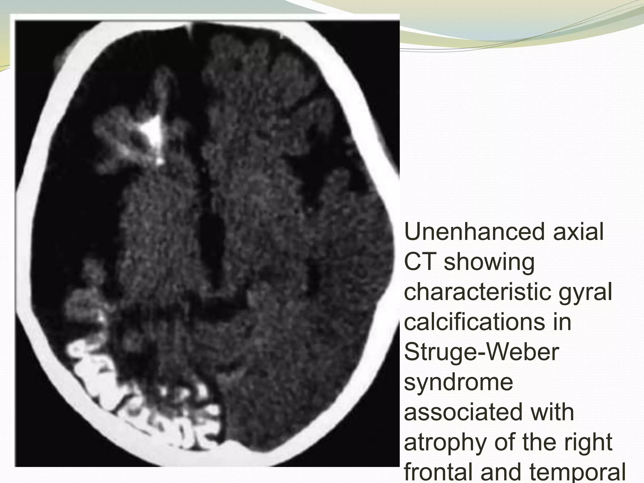 PHYSIOLOGICAL AND PATHOLOGICAL CALCIFICATION OF BRAIN | PPTX