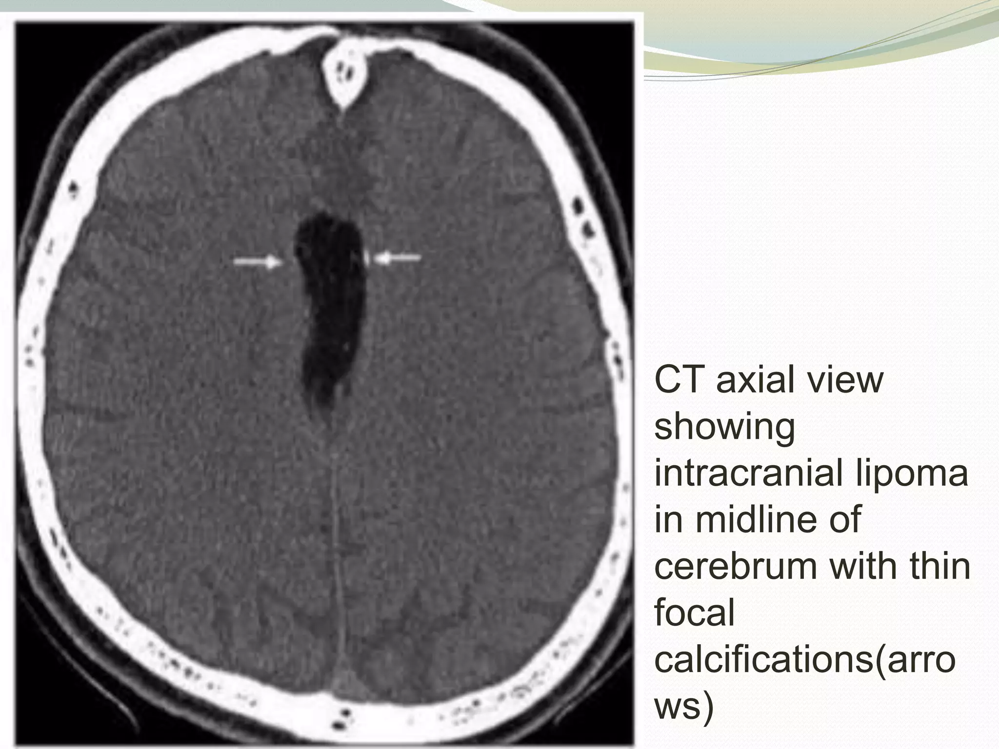 PHYSIOLOGICAL AND PATHOLOGICAL CALCIFICATION OF BRAIN | PPTX