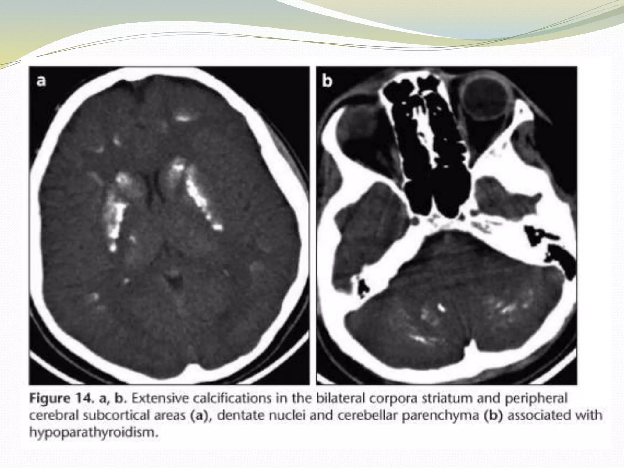 PHYSIOLOGICAL AND PATHOLOGICAL CALCIFICATION OF BRAIN | PPTX