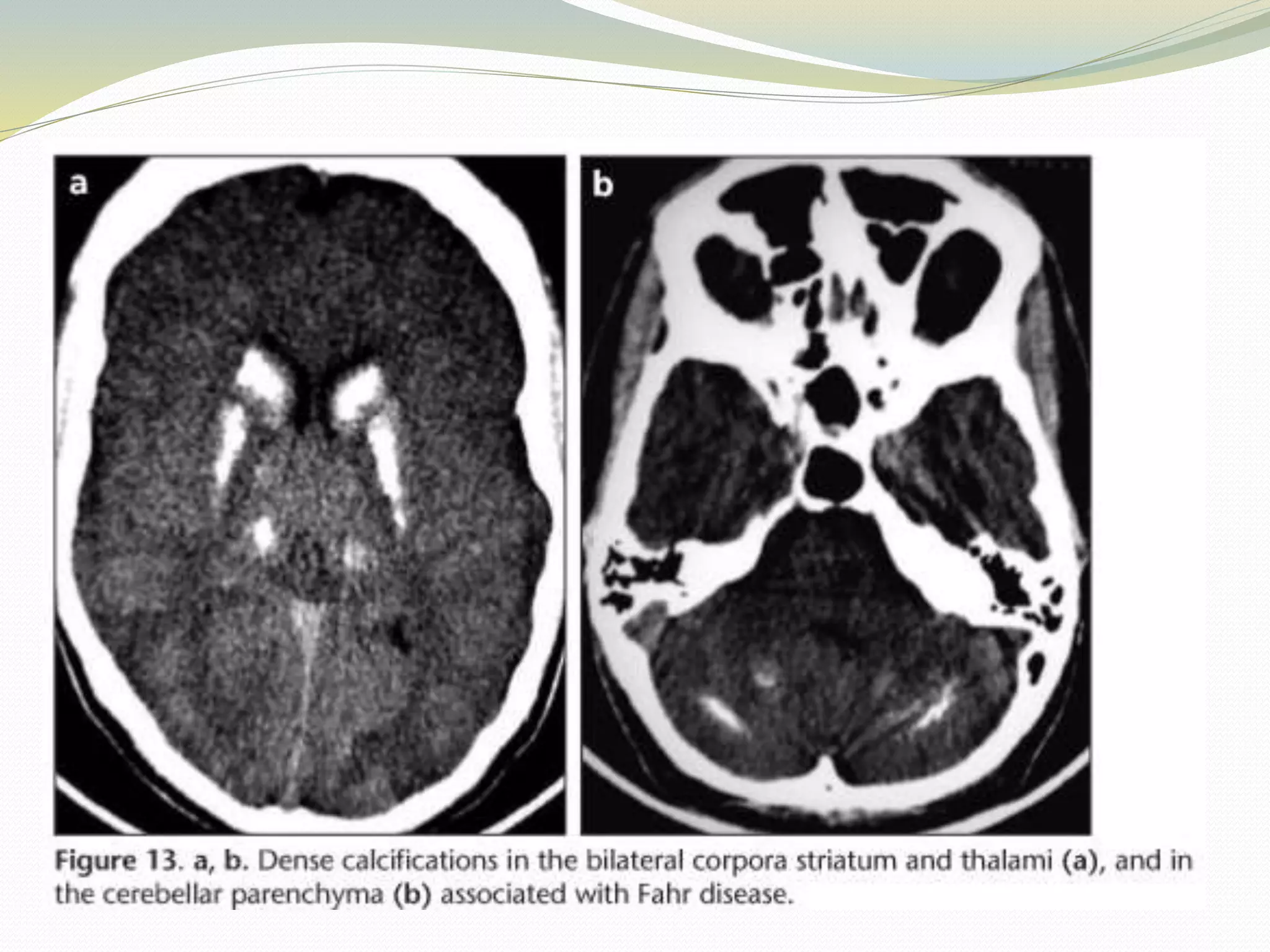 PHYSIOLOGICAL AND PATHOLOGICAL CALCIFICATION OF BRAIN | PPTX