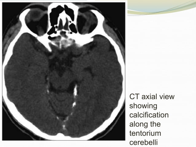 PHYSIOLOGICAL AND PATHOLOGICAL CALCIFICATION OF BRAIN | PPTX