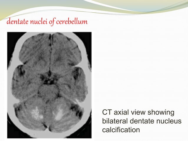 Physiological And Pathological Calcification Of Brain Ppt