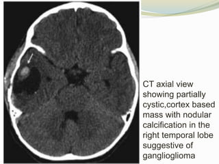 PHYSIOLOGICAL AND PATHOLOGICAL CALCIFICATION OF BRAIN | PPTX