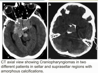 PHYSIOLOGICAL AND PATHOLOGICAL CALCIFICATION OF BRAIN | PPTX