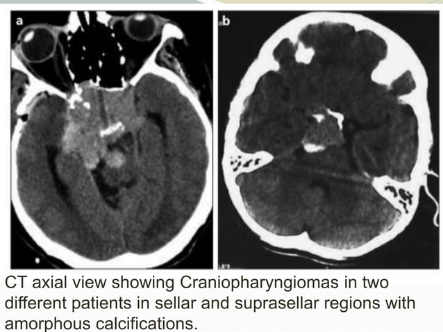 PHYSIOLOGICAL AND PATHOLOGICAL CALCIFICATION OF BRAIN | PPTX