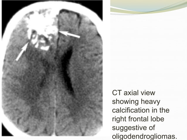 PHYSIOLOGICAL AND PATHOLOGICAL CALCIFICATION OF BRAIN | PPTX