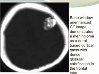 PHYSIOLOGICAL AND PATHOLOGICAL CALCIFICATION OF BRAIN | PPTX