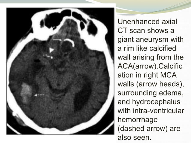 PHYSIOLOGICAL AND PATHOLOGICAL CALCIFICATION OF BRAIN | PPTX