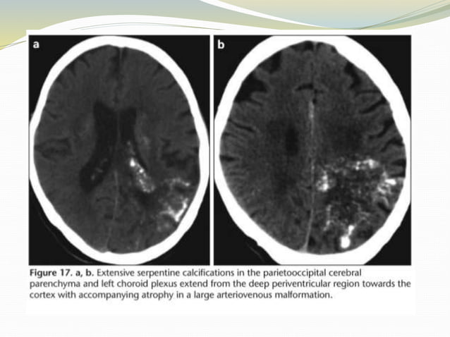 PHYSIOLOGICAL AND PATHOLOGICAL CALCIFICATION OF BRAIN | PPTX