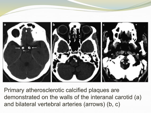 PHYSIOLOGICAL AND PATHOLOGICAL CALCIFICATION OF BRAIN | PPTX