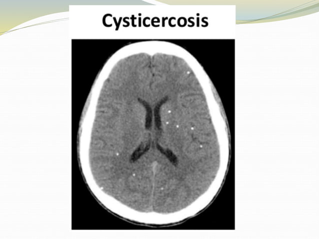 PHYSIOLOGICAL AND PATHOLOGICAL CALCIFICATION OF BRAIN | PPTX