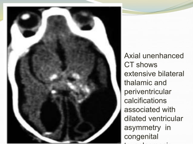 PHYSIOLOGICAL AND PATHOLOGICAL CALCIFICATION OF BRAIN | PPTX